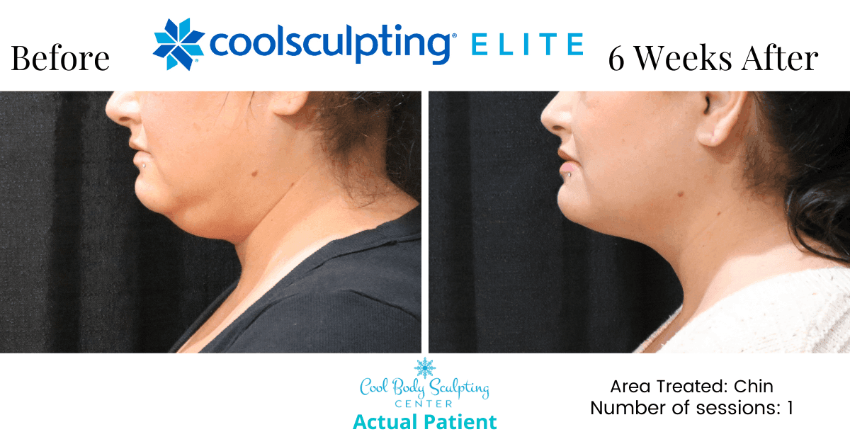 Cool Body Sculpting Center - Cool Body Sculpting Center | Virginia ...