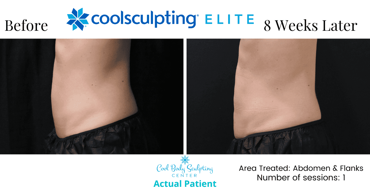Cool Body Sculpting Center-CoolSculpting Price