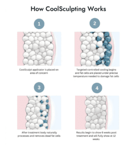 What Is Cool Sculpting? How Does Coolsculpting Work? Virginia Beach VA