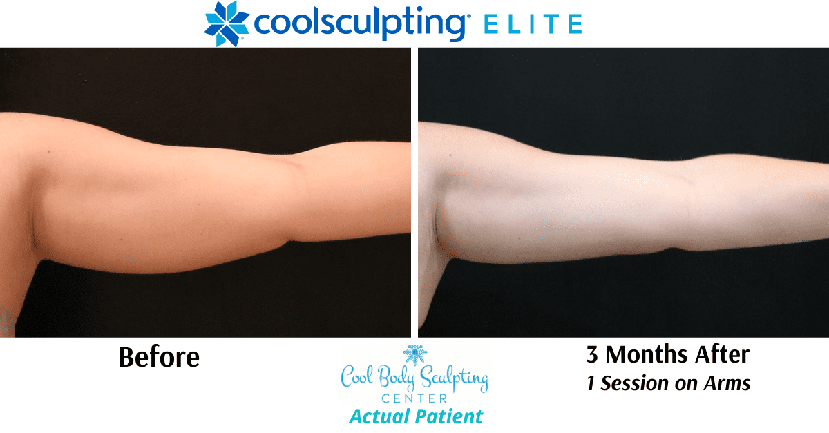 How to lose arm fat fast - Cool Body Sculpting Center | Virginia Beach, VA